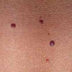 Qué son los lunares | Cómo diferenciar un melanoma