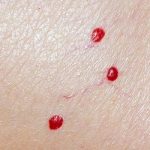 Qué son los lunares | Cómo diferenciar un melanoma